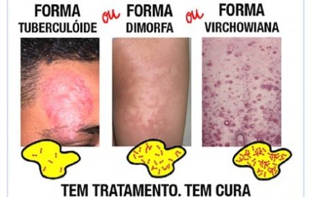 Hanseníase: aprenda mais - Clínica Dra. Juliana Toma