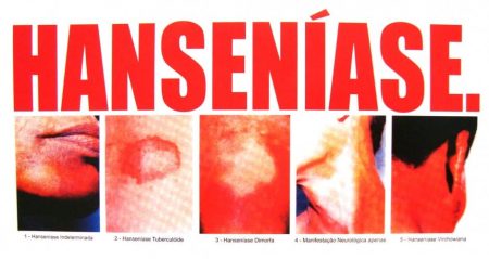 Hanseníase: aprenda mais - Dra. Juliana Toma