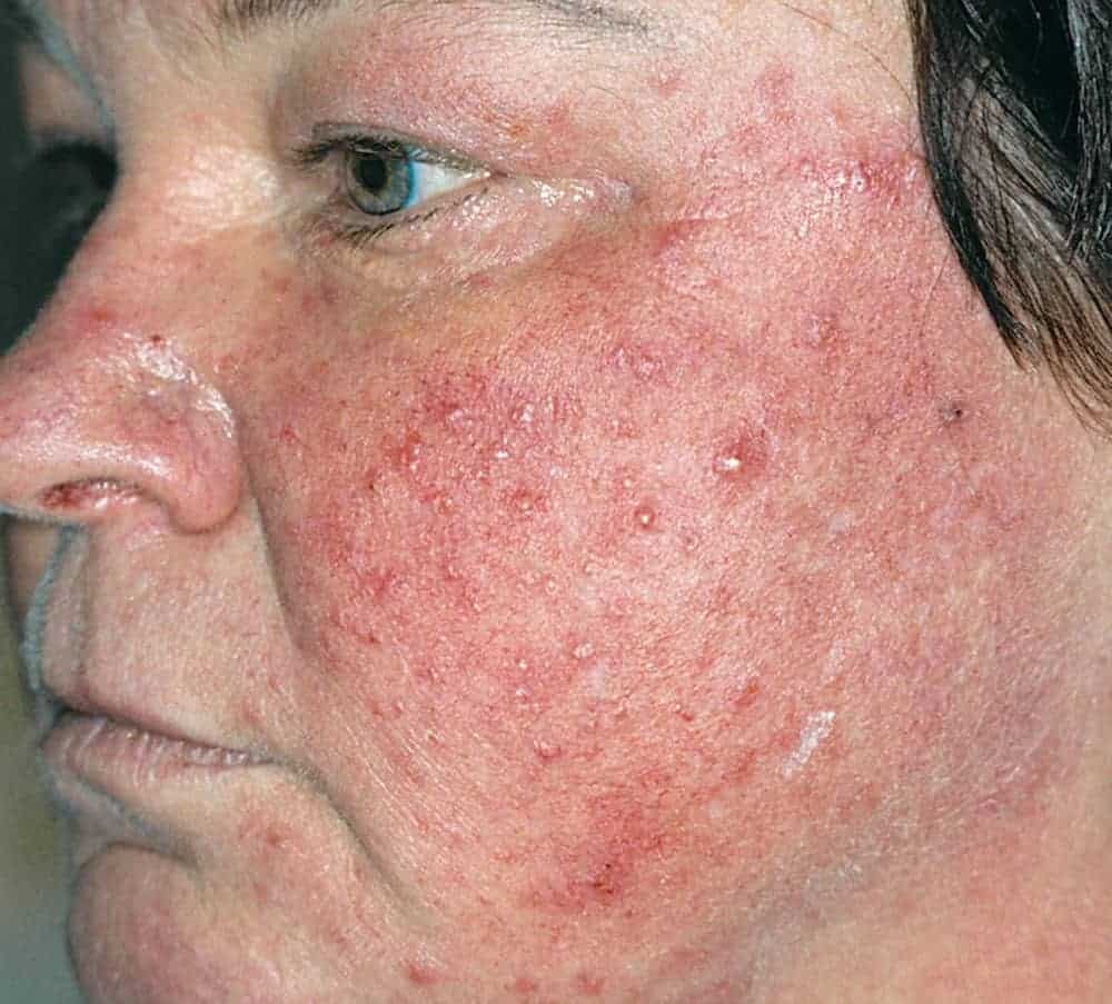 Hiperplasia Sebácea - Saiba mais sobre essa doença de pele - Clínica ... Hiperplasia Sebácea - Saiba mais sobre essa doença de pele - Clínica ...