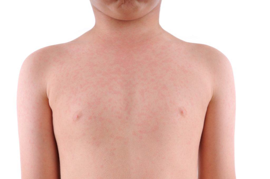 Como tratar Urticária - Instituto Dra. Juliana Toma
