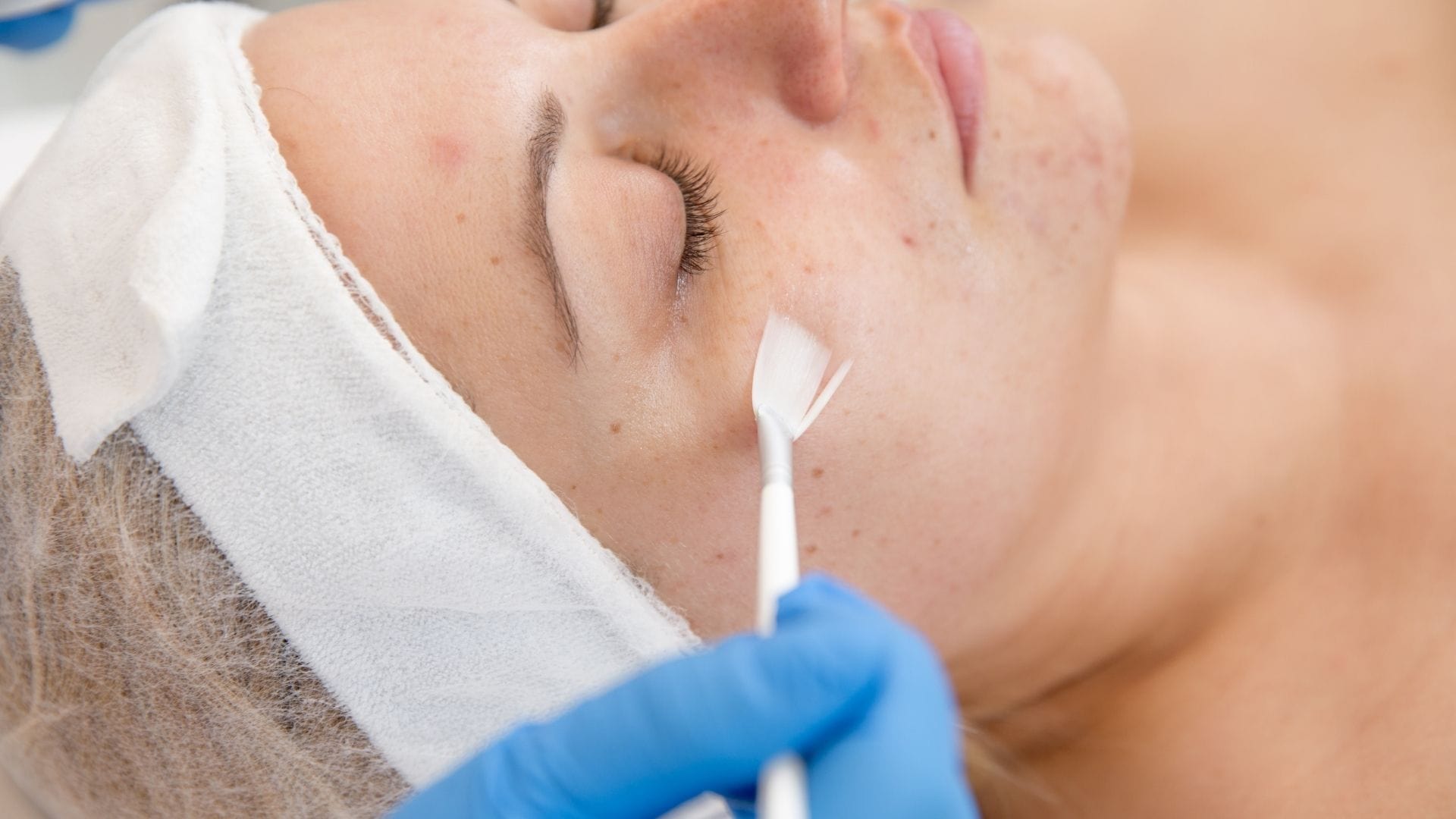 Peeling Químico - Clínica de Dermatologia em São Paulo