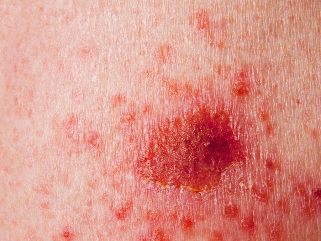 Queratose actínica - Dra. Juliana Toma