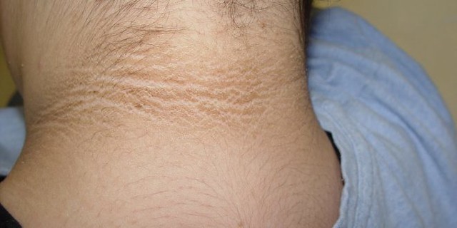 Acantose nigricans - o que é, causas, sintomas e tratamento - Clínica ...