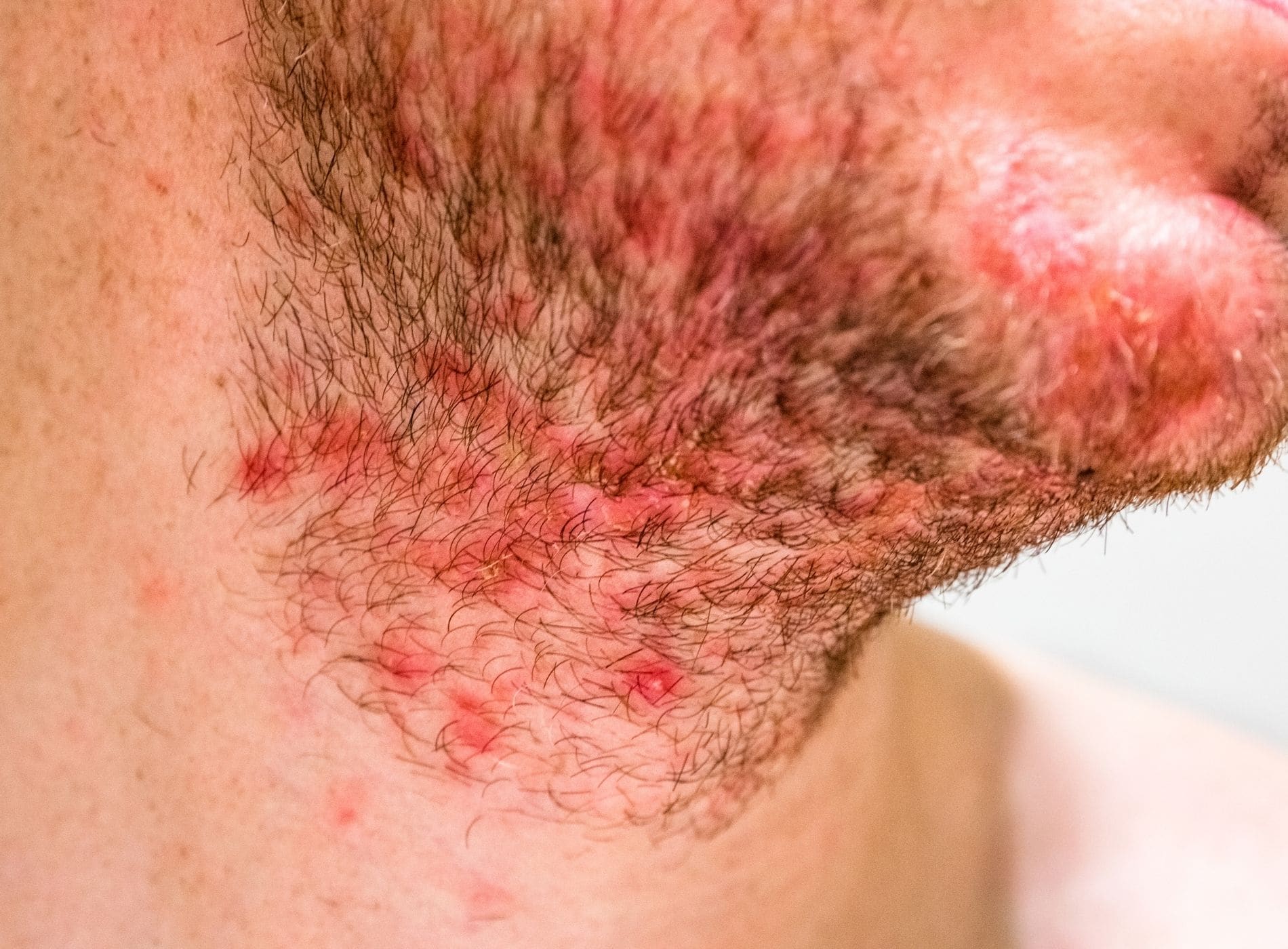 Piodermite Humana é Contagiosa - RETOEDU