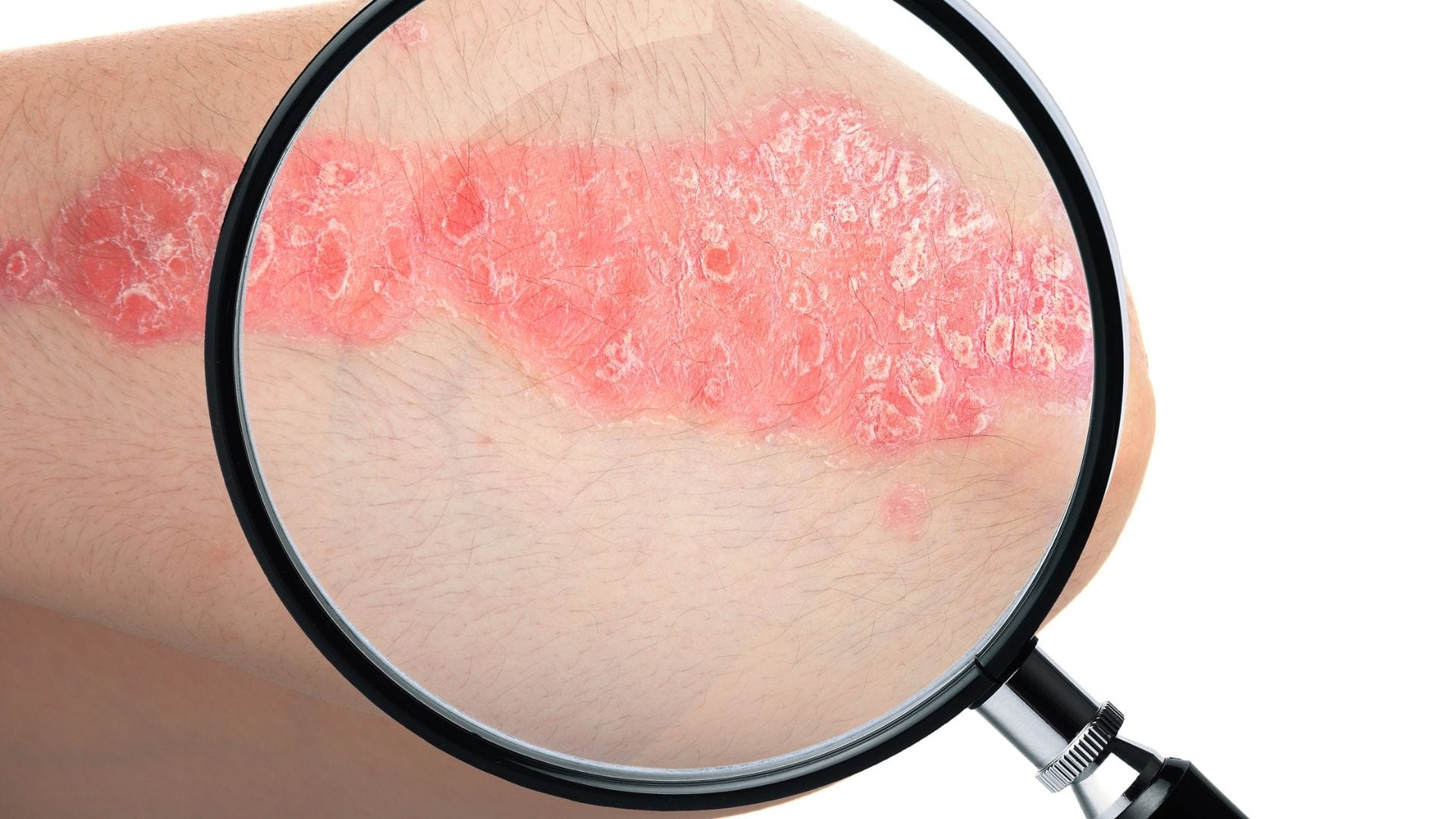 Psoríase invertida - entenda o que é, sintomas e tratamento - Clínica ...
