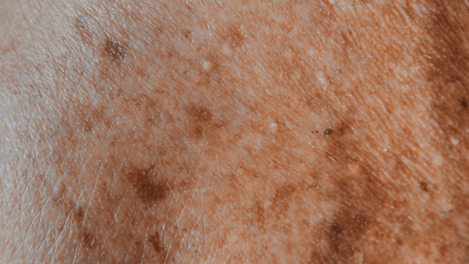 Melanoses/manchas de sol - entenda mais sobre o assunto - Dra. Juliana Toma